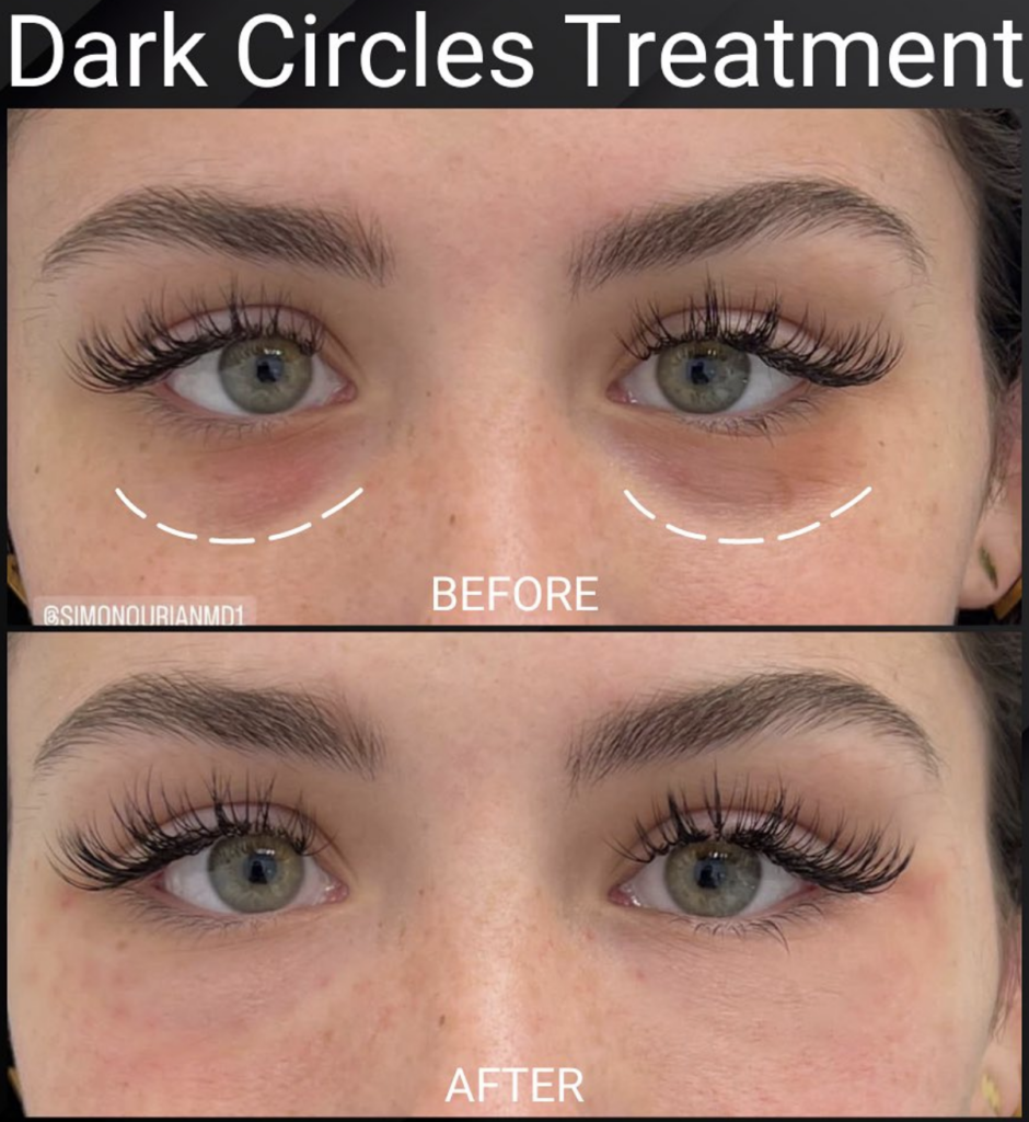 Why Do Dark Circles Appear Under the Eyes? | Epione