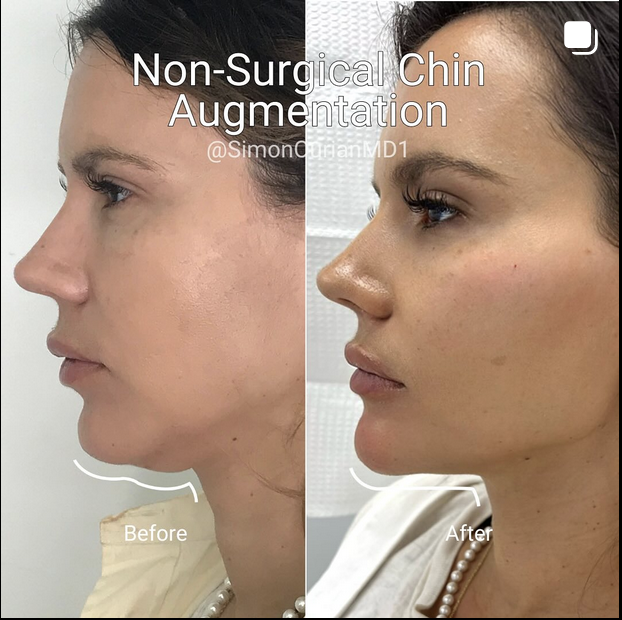 Understanding the chin augmentation process: What you need to know | Epione