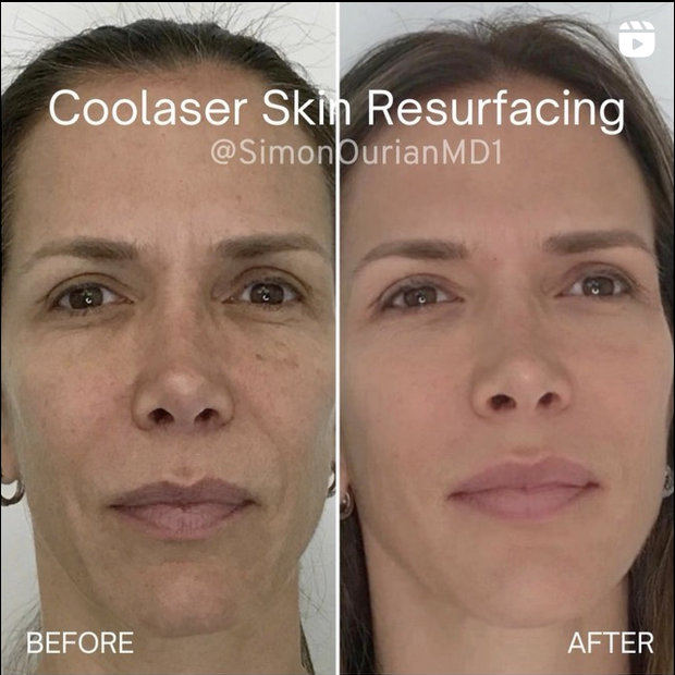 Understanding the value of Coolaser in skin resurfacing: What you need ...