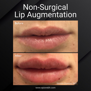 Want to remove wrinkles on the upper lip? Discover the secrets to ...