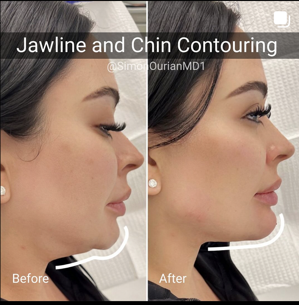 Non-surgical double chin reduction: How to reclaim your jawline without surgery | Epione