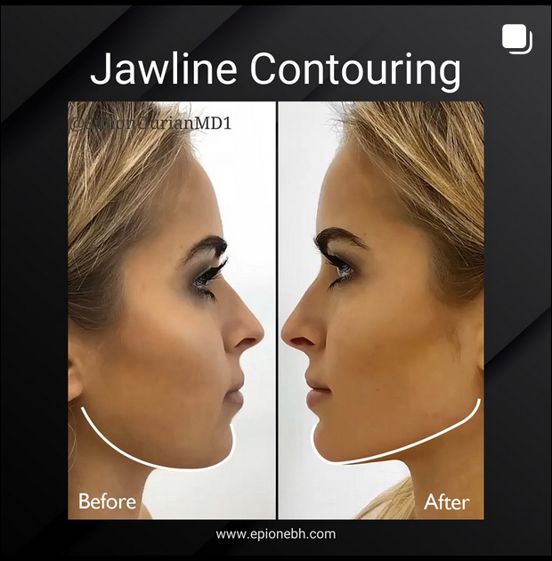 Thread lift for double chin reduction: Is It the solution you have been ...
