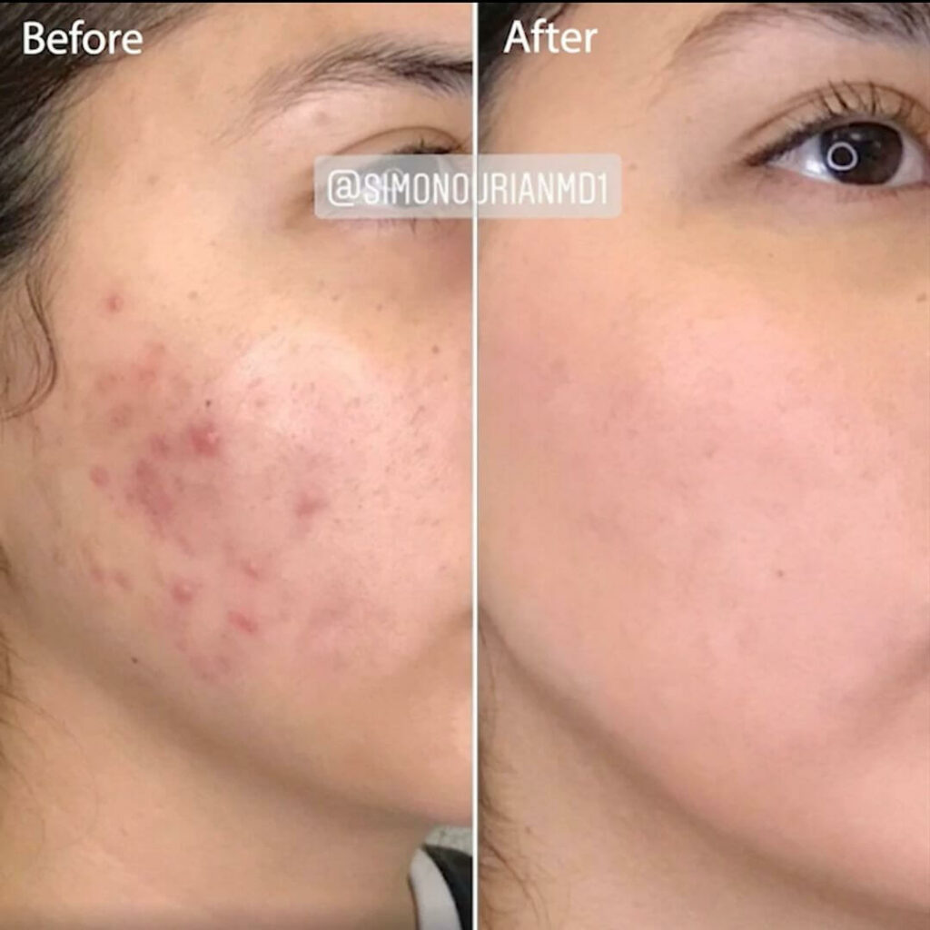 Acne-Scar Removal: Types, Causes and The Innovative Treatment. | Epione